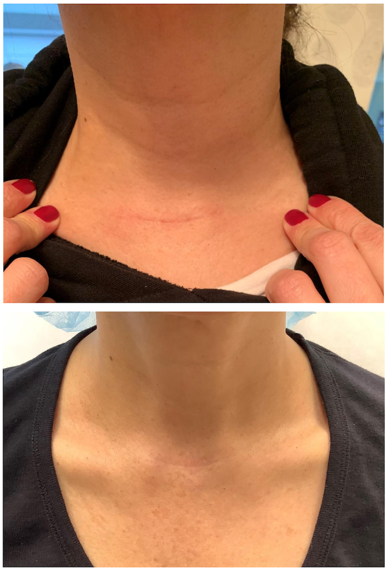 Scars Removal NYC | Keloid Scar Removal Greenwich