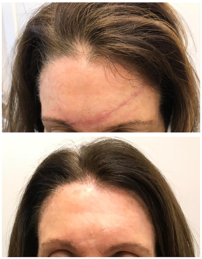 Scars Removal NYC | Keloid Scar Removal Greenwich